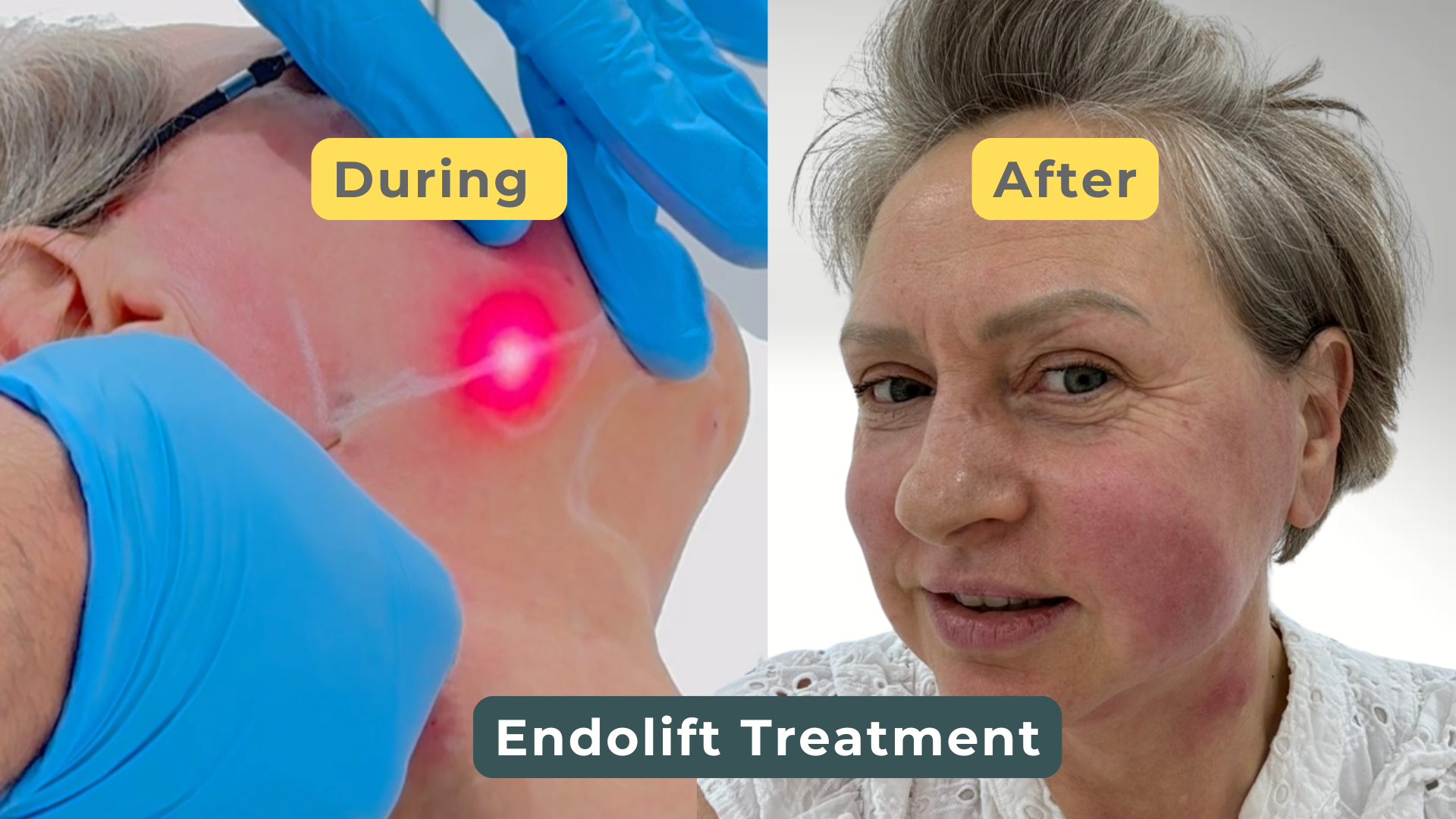 Endolift Vs HIFU: Which Treatment Best Tightens Skin And Reduces Fat?